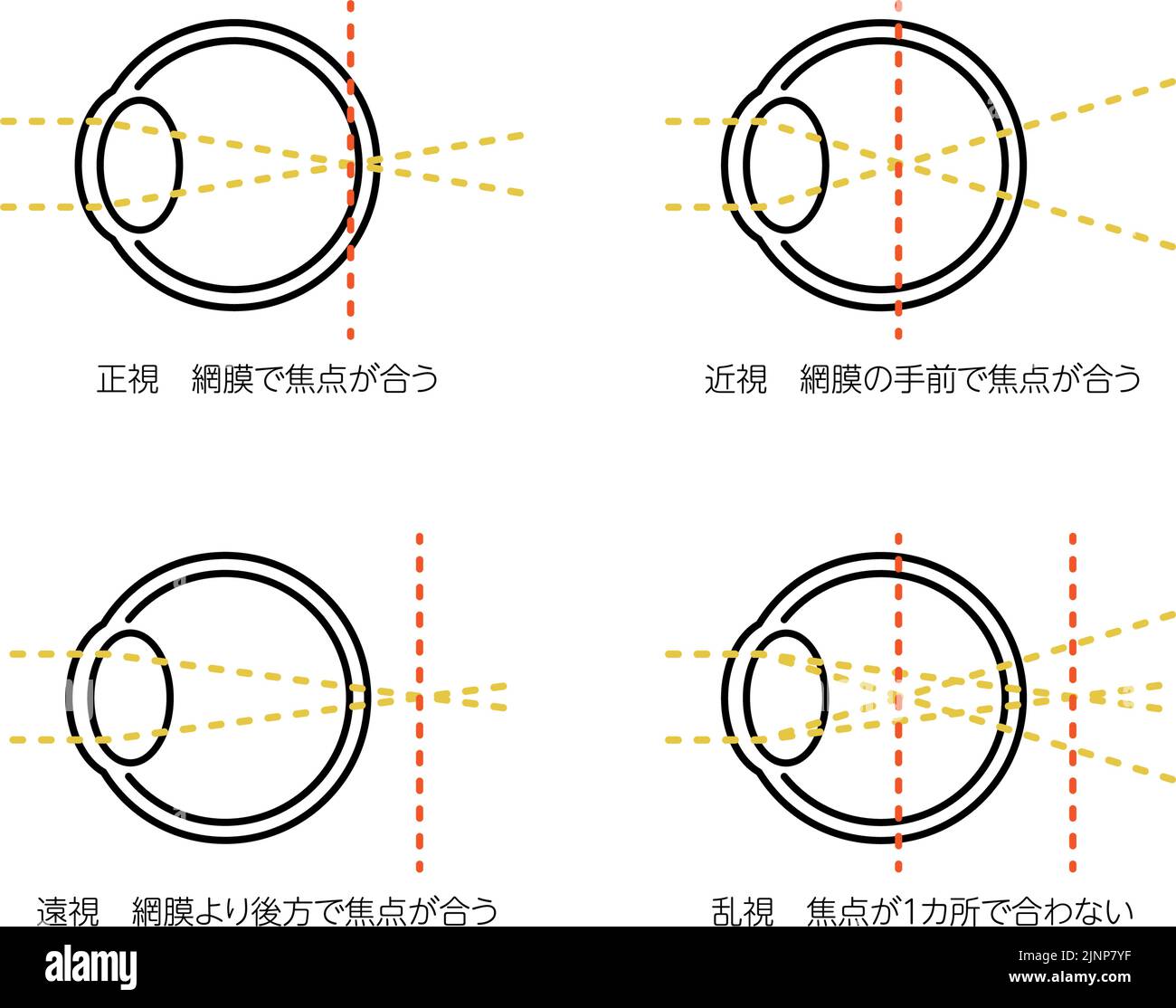 Refractive Error, Normal, Myopia, Hyperopia, Astigmatism - Translation ...