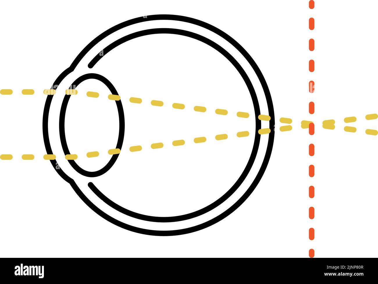 Medical Illustration of Visual Acuity and Refractive Error, Hyperopia ...