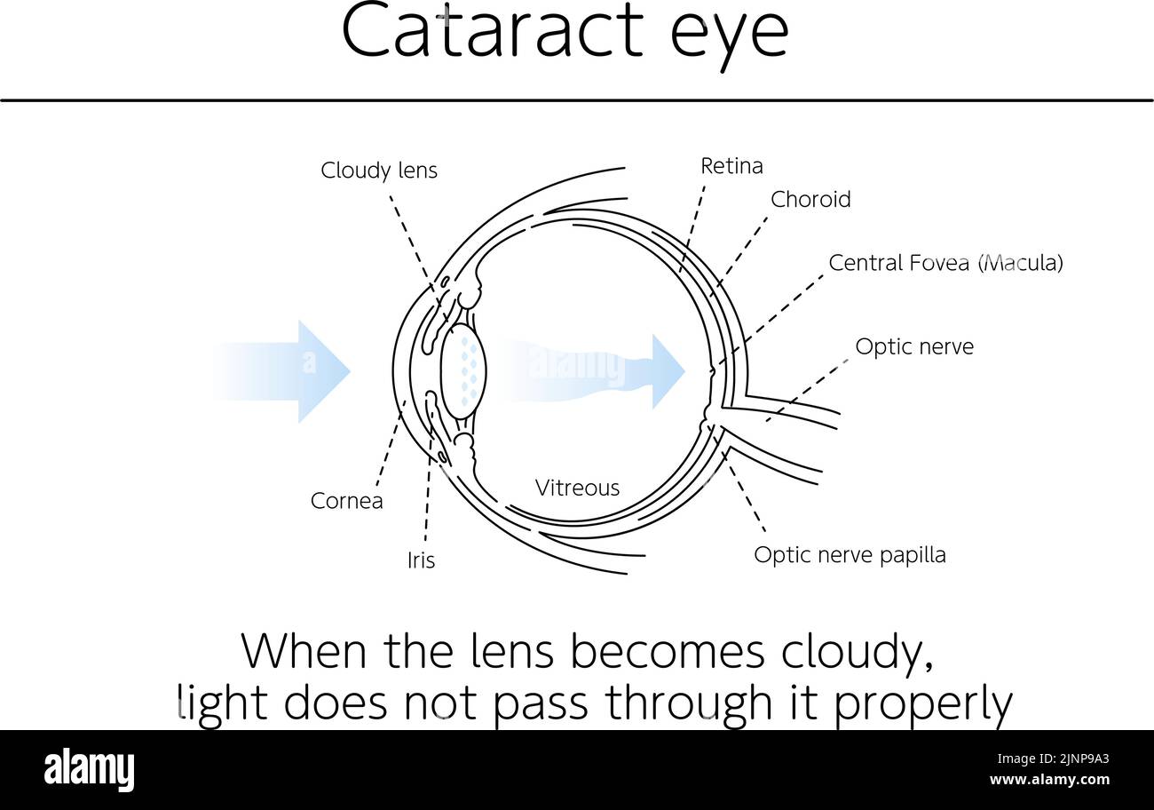 Illustration, Cataract eye, Medical Illustrations Stock Vector Image ...