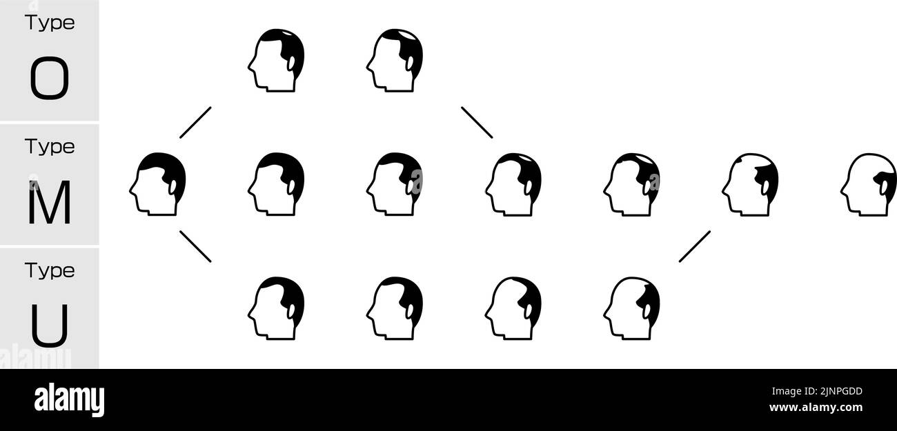 Illustration of each type of AGA androgenetic alopecia and progress ...