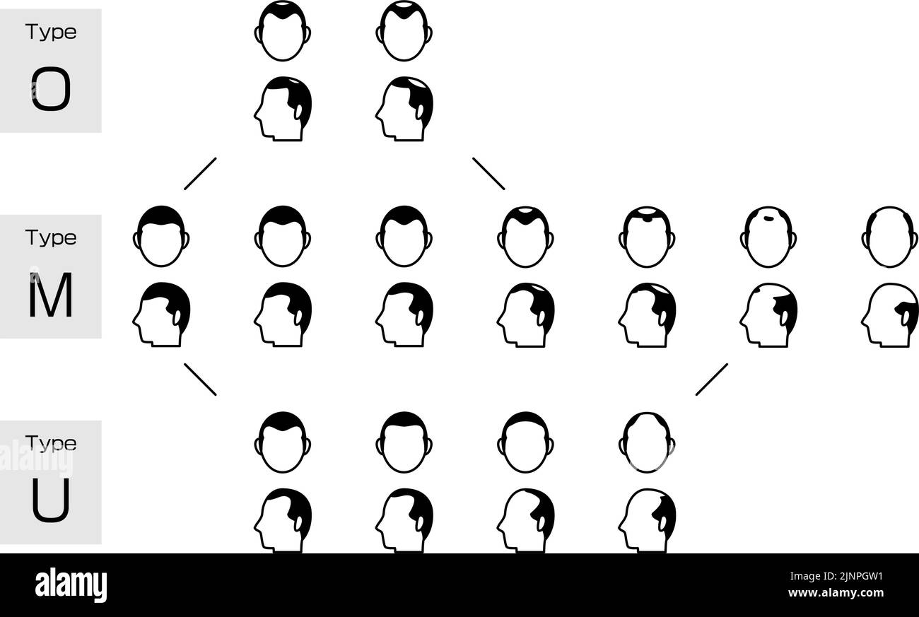 Illustration of each type of AGA androgenetic alopecia and progress ...