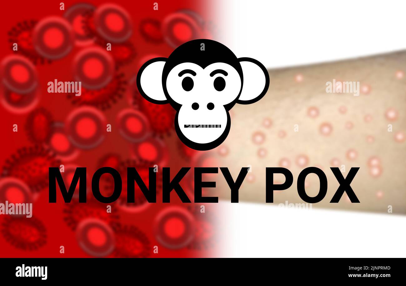 monkey pox virus pendamic background with blur infected hand and virus ...