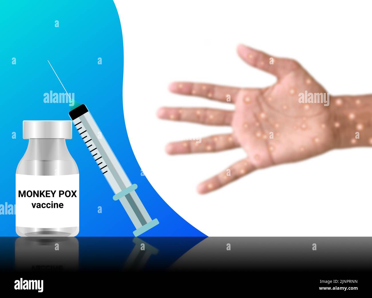 monkey pox virus vaccine and injection on blur infected hand. new ...