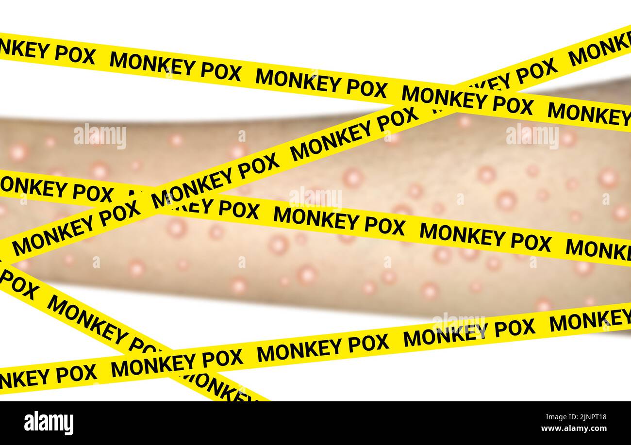 monkey pox yellow crime spot line on blur pox virus in human body Stock ...
