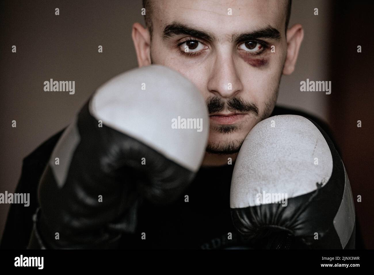 Young male with bruise under his eye with boxing gloves Stock Photo - Alamy