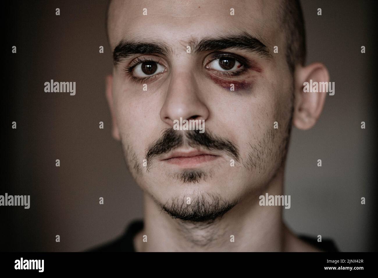 Injured young man with bruises on his face Stock Photo - Alamy