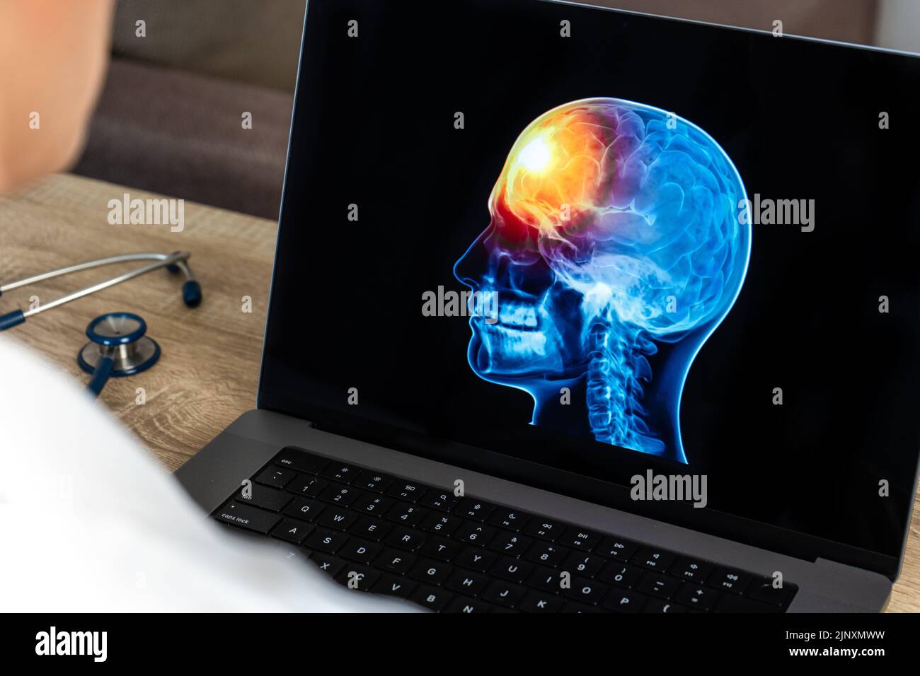 Close up of doctor looking a x-ray of pain in the brain on a laptop ...