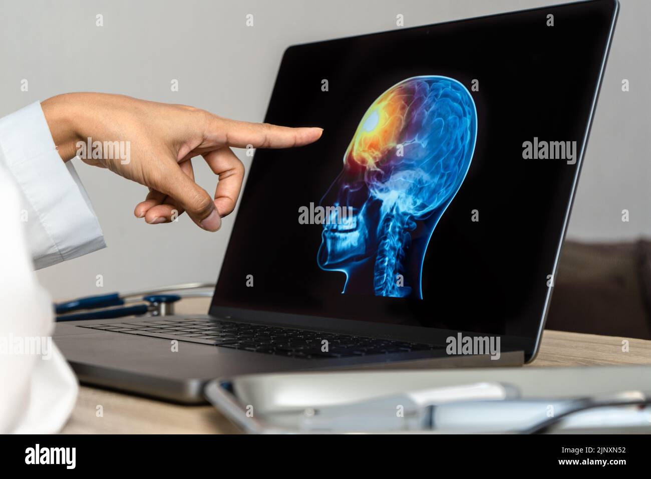 Close up of doctor looking a x-ray of pain in the brain on a laptop ...