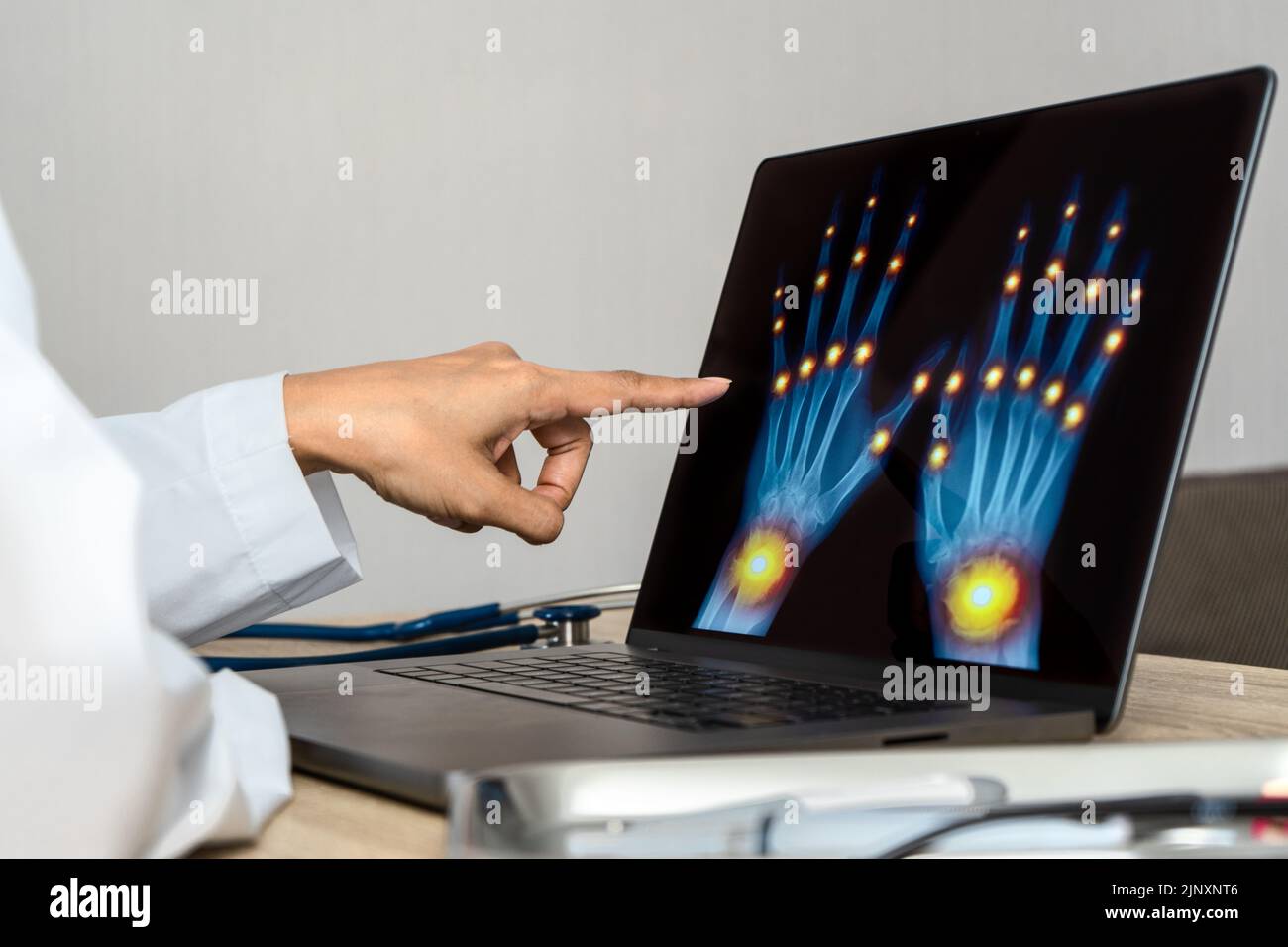 Close up of doctor showing x-ray of hands Stock Photo - Alamy