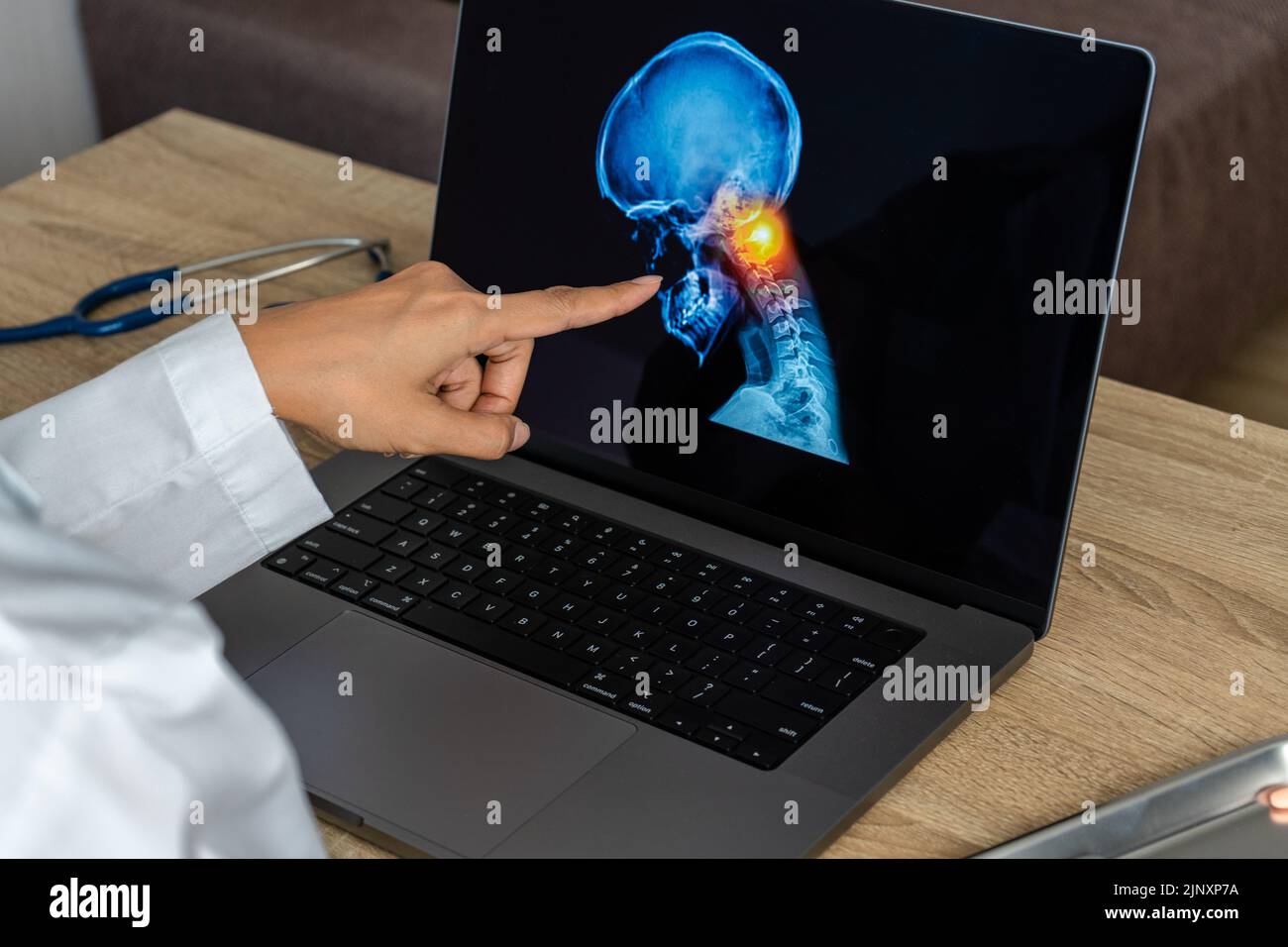 Doctor showing a x-ray of pain in the neck. Migraine Headache and ...