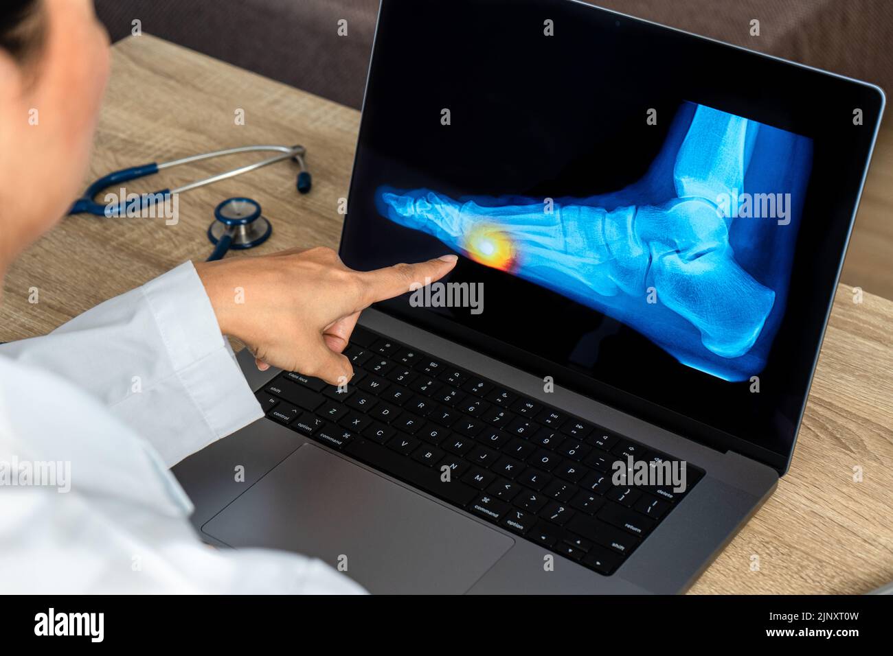 Close up of doctor showing a x-ray of foot. Pain foot injury Stock ...
