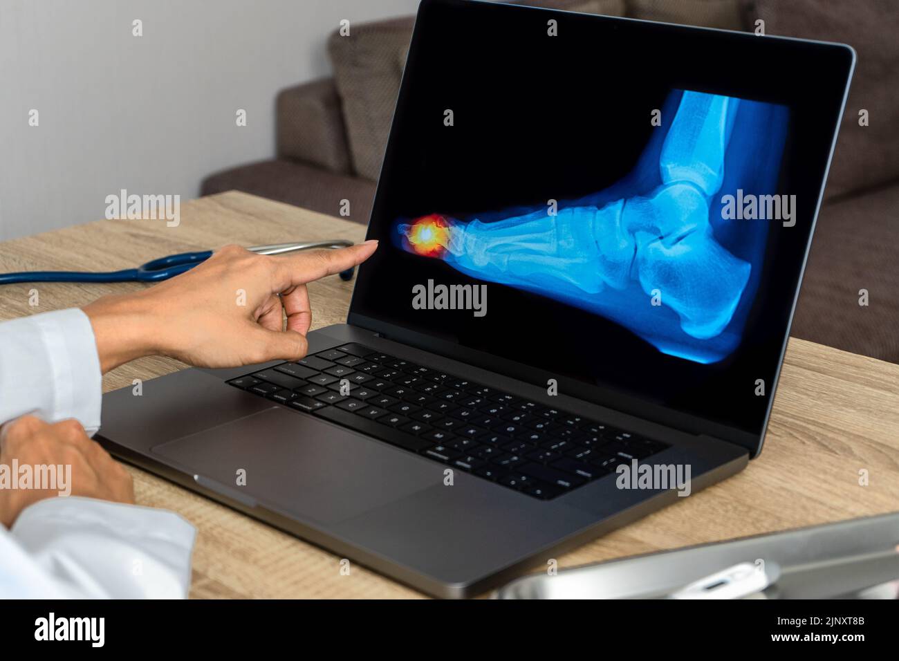 Close up of doctor showing a x-ray of foot. Pain toes injury Stock ...