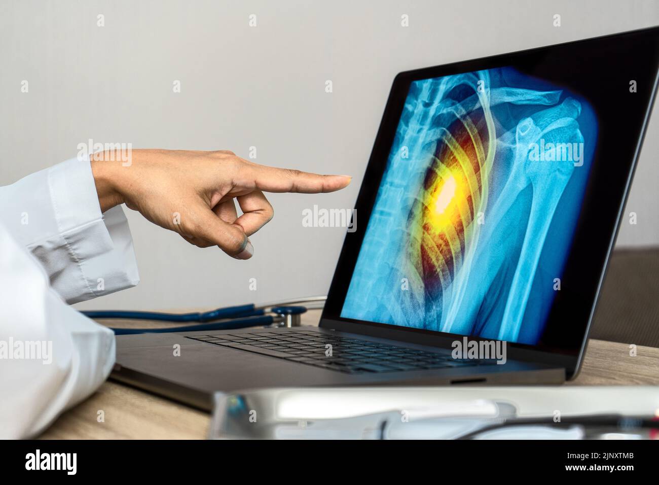 Doctor showing a x-ray of pain in the ribs. Heart attack or chest ...