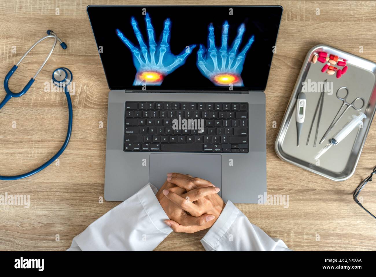 X ray hands arthritis hi-res stock photography and images - Alamy
