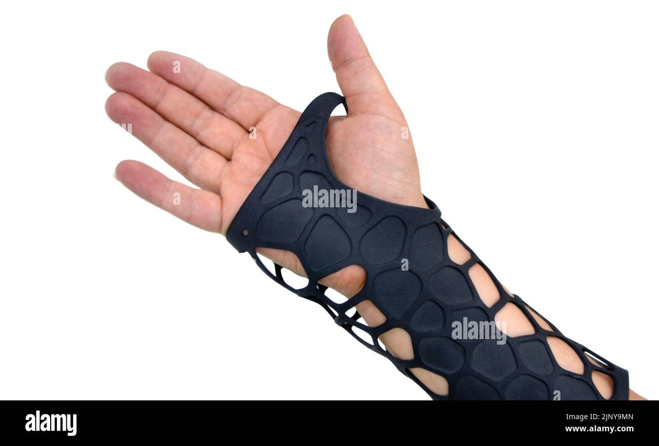 Orthopedic plastic prosthesis printed on powder 3D printer on hand ...