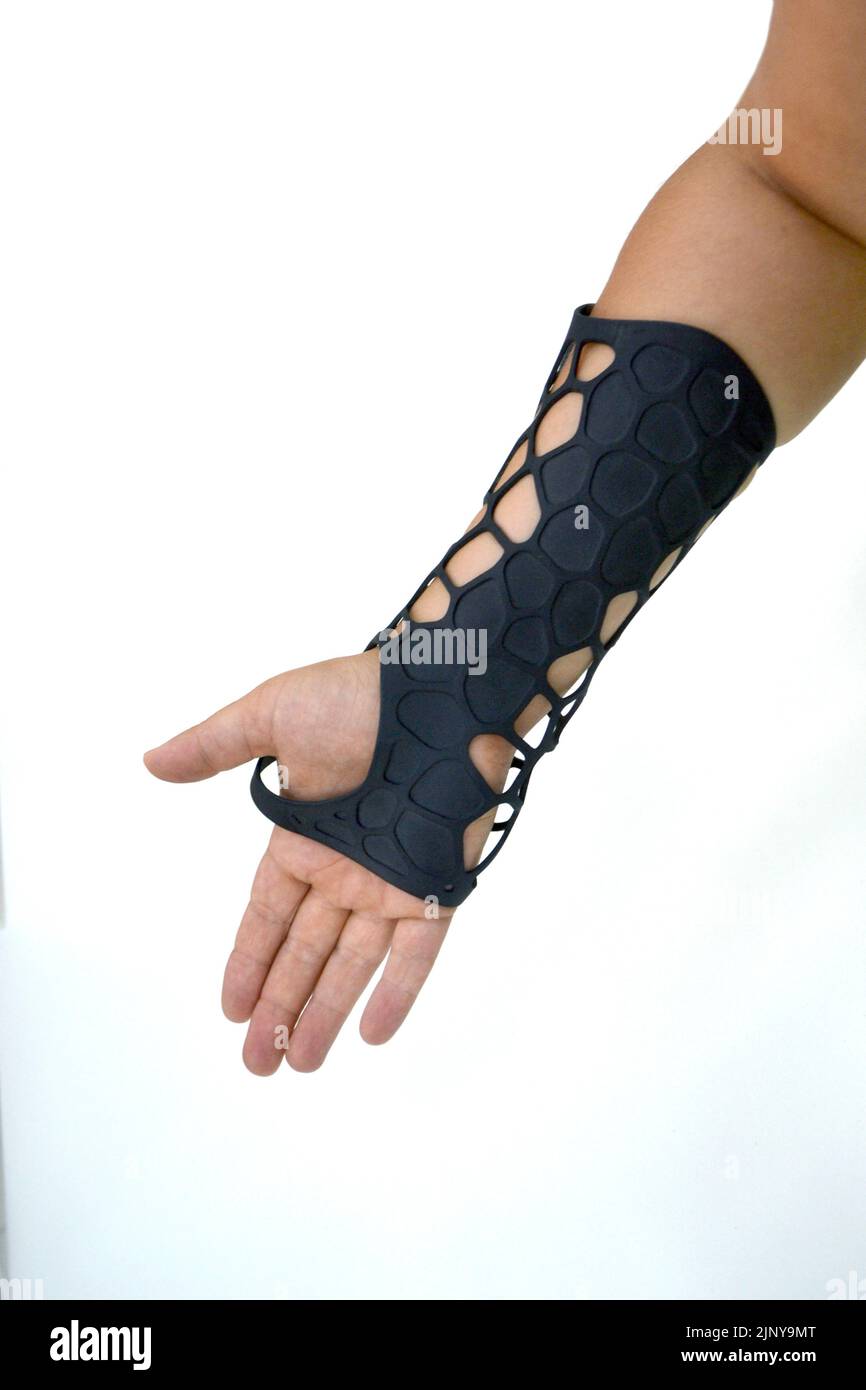 Orthopedic plastic prosthesis printed on powder 3D printer on hand ...