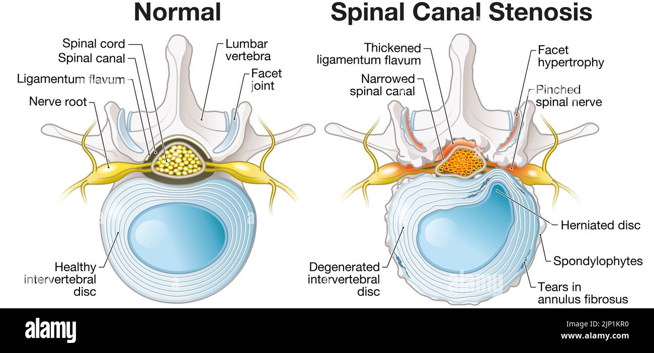 Illustration showing spinal canal stenosis lumbar vertebra with ...