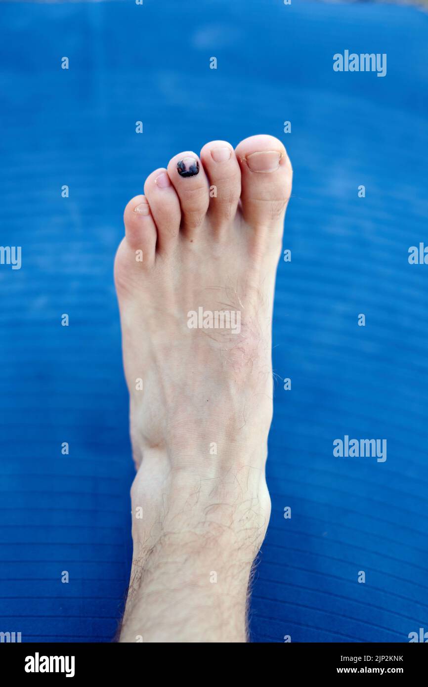 A vertical shot of a foot with a black toenail Stock Photo - Alamy