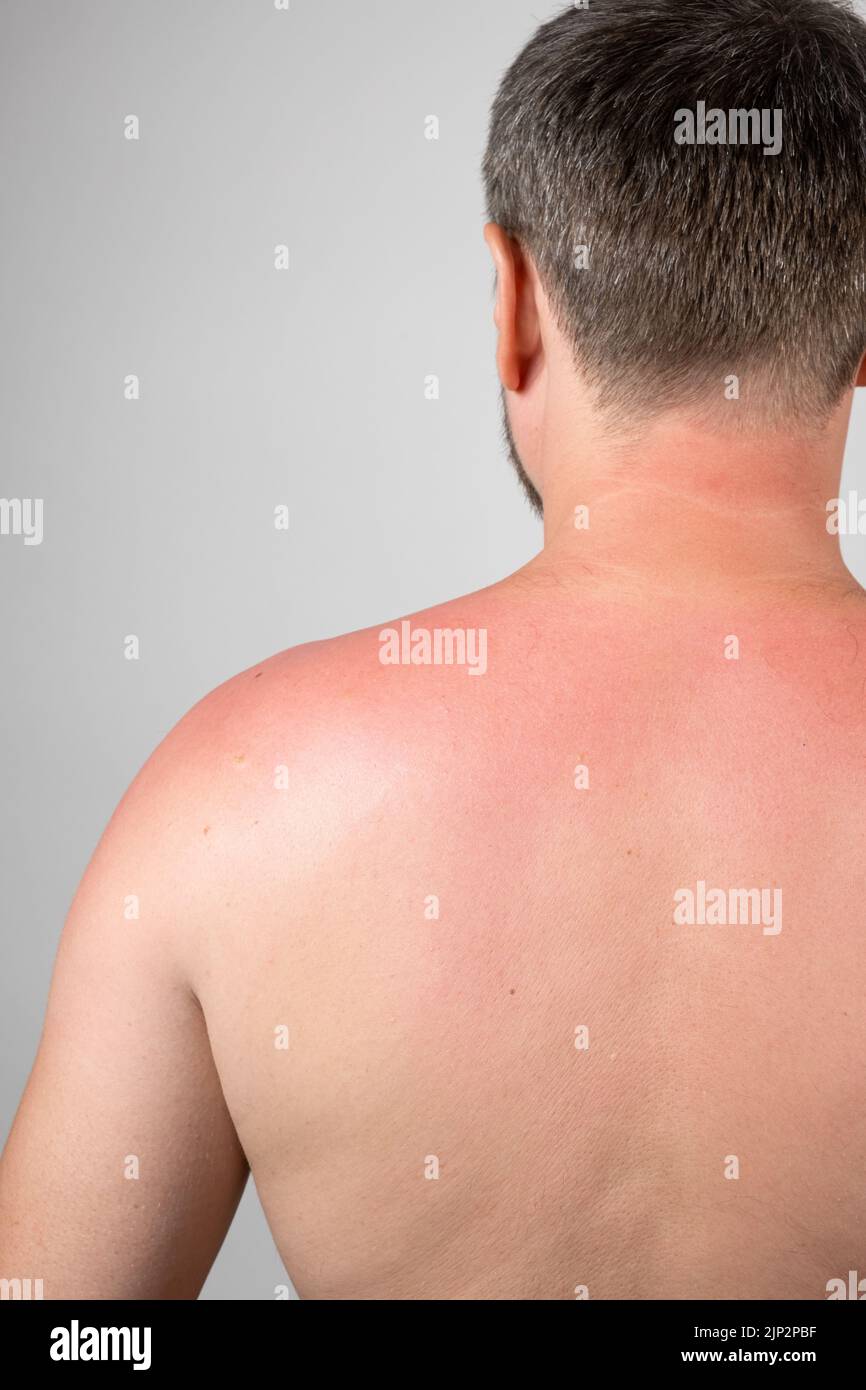 Back of a man with a sunburn, close-up Stock Photo - Alamy