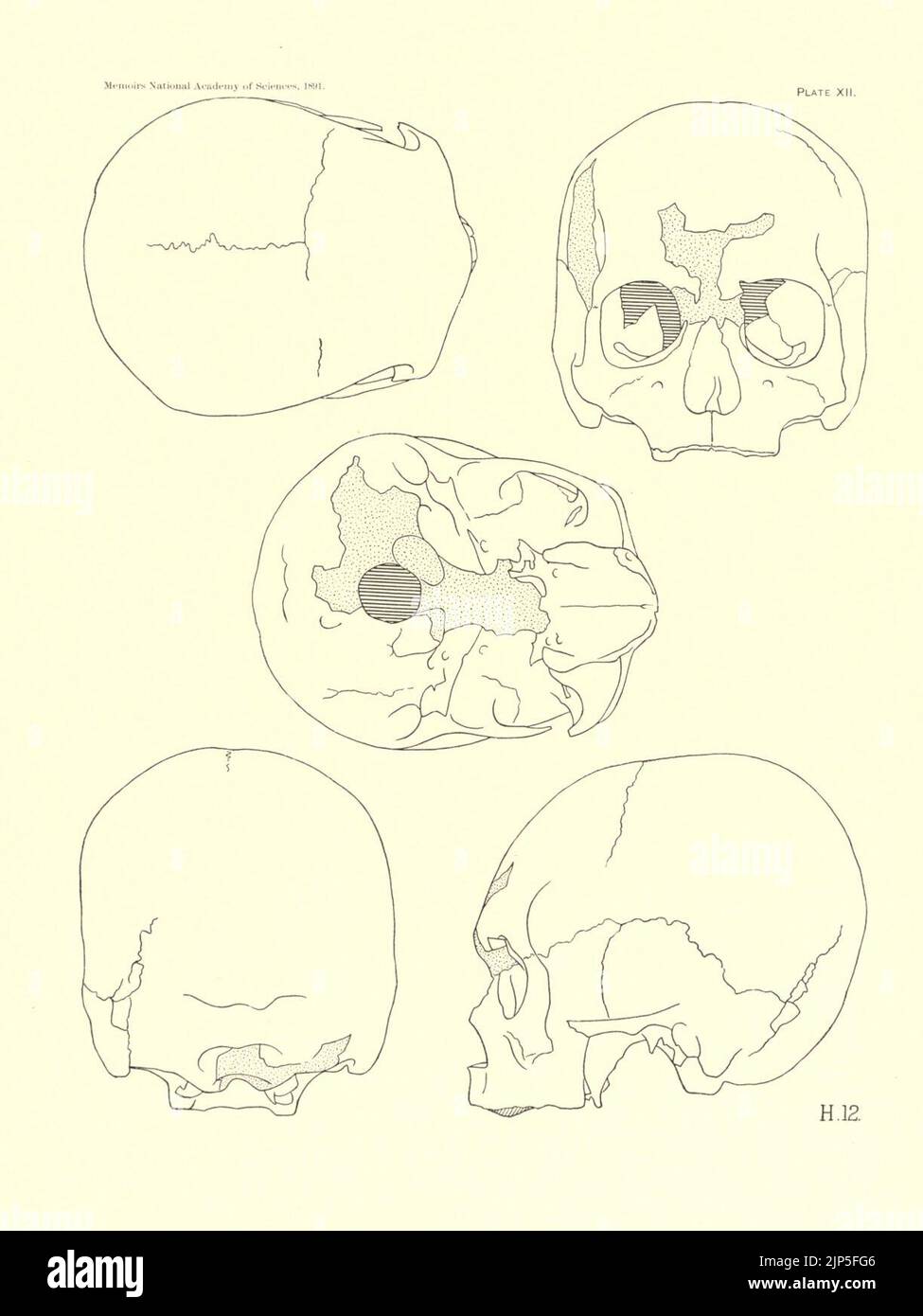 The human bones of the Hemenway collection in the United States Army ...