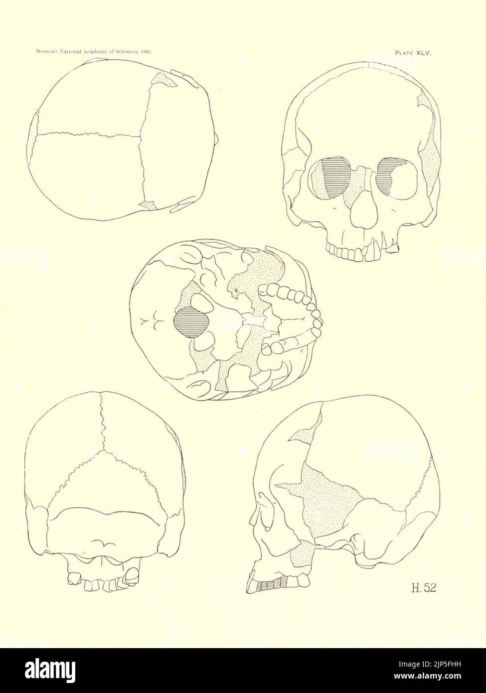The human bones of the Hemenway collection in the United States Army ...