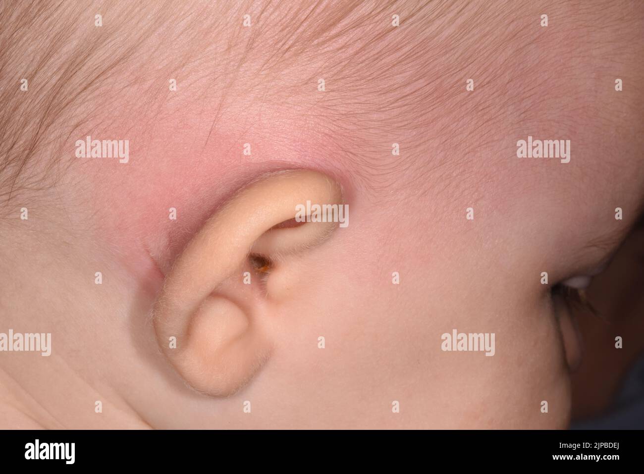 Distortion of ear due to acute mastoiditis Stock Photo - Alamy