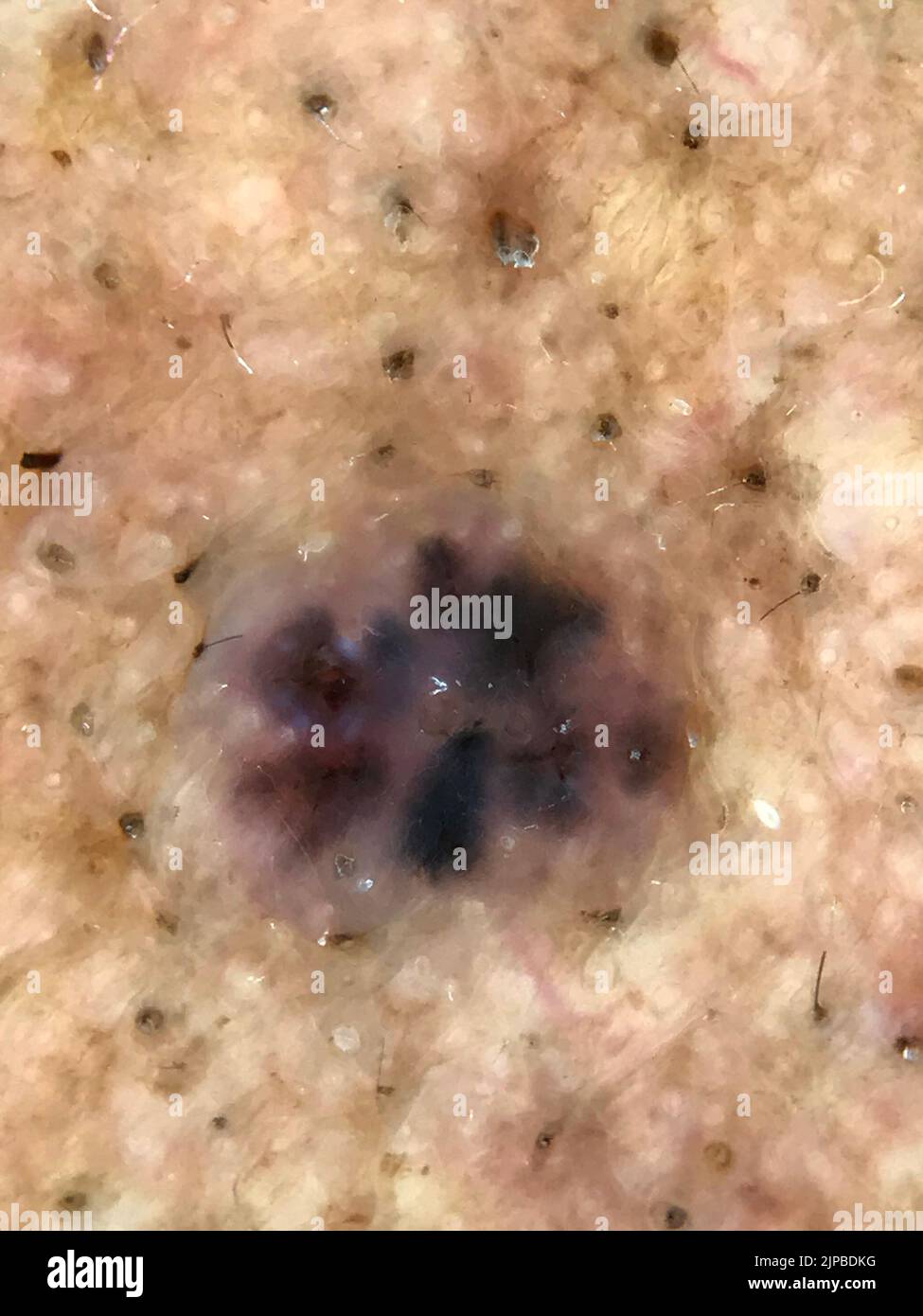 Basal cell carcinoma, dermoscopy Stock Photo - Alamy