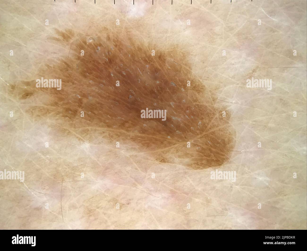 Seborrheic keratosis, dermoscopy Stock Photo - Alamy