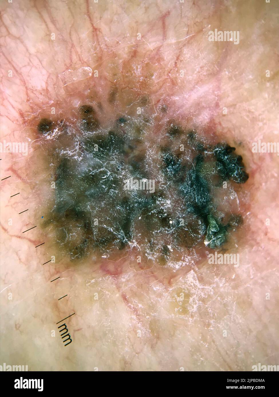 Basal cell carcinoma, dermoscopy Stock Photo - Alamy