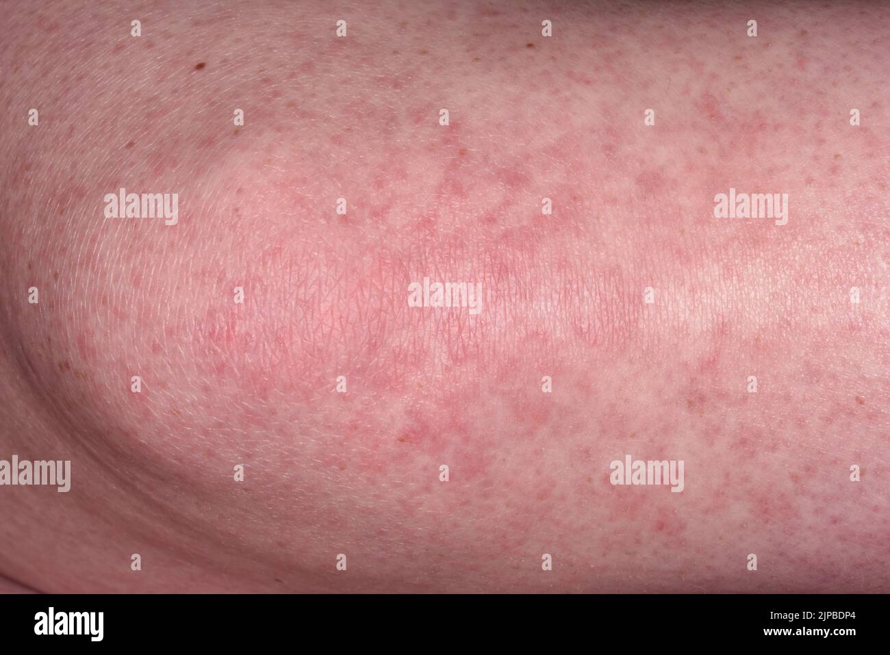 Systemic lupus erythematosus rash after Covid vaccine Stock Photo - Alamy