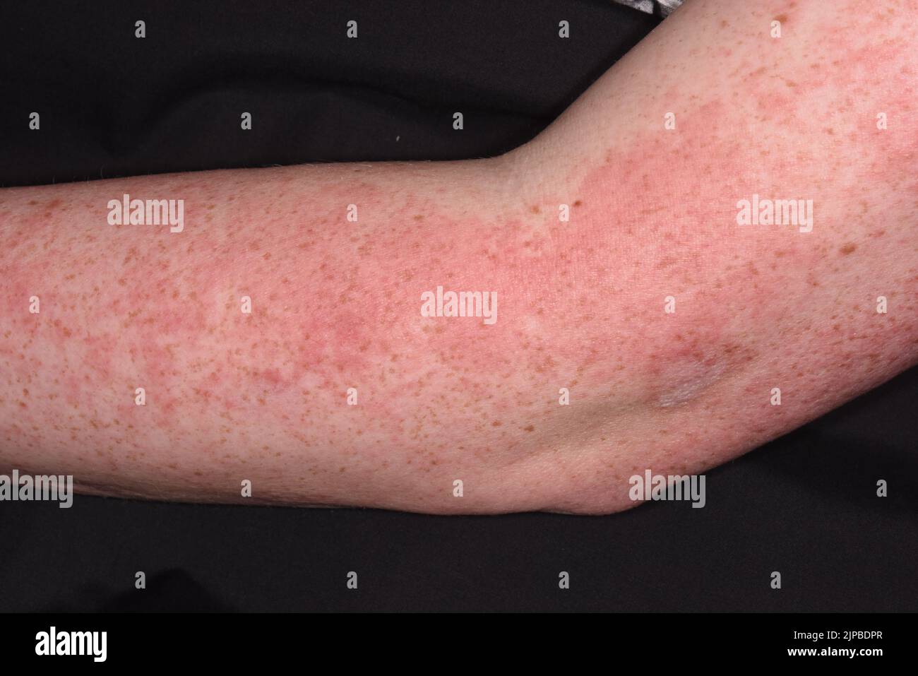 Systemic lupus erythematosus rash after Covid vaccine Stock Photo - Alamy