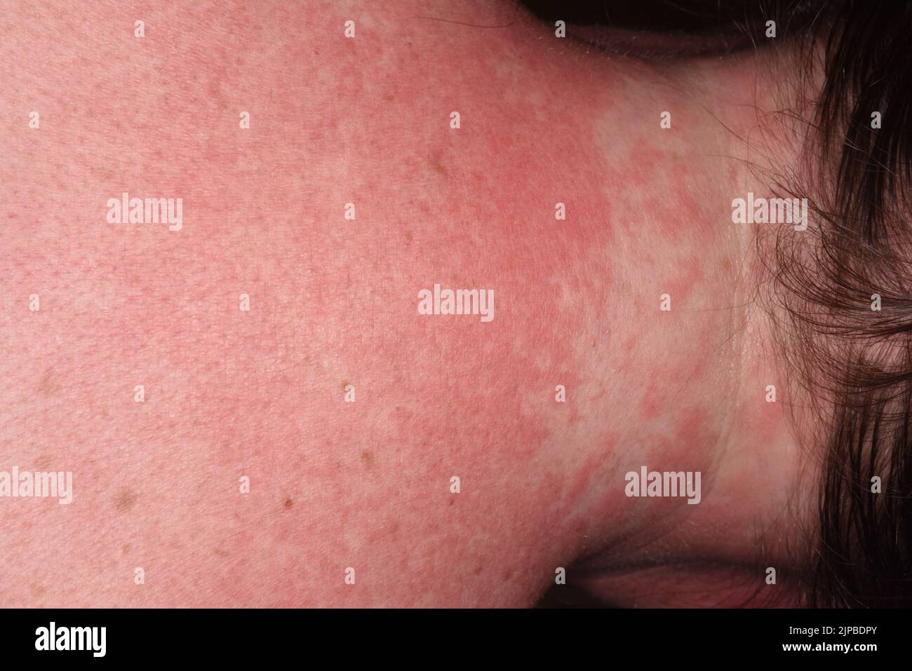 Systemic lupus erythematosus rash after Covid vaccine Stock Photo - Alamy