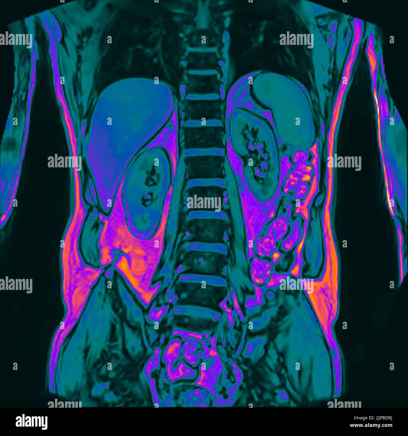 Kidney stone, MRI scan Stock Photo - Alamy