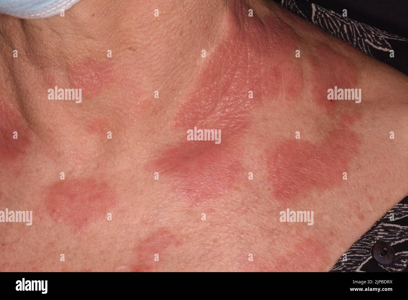 Cutaneous lupus erythematosus Stock Photo - Alamy