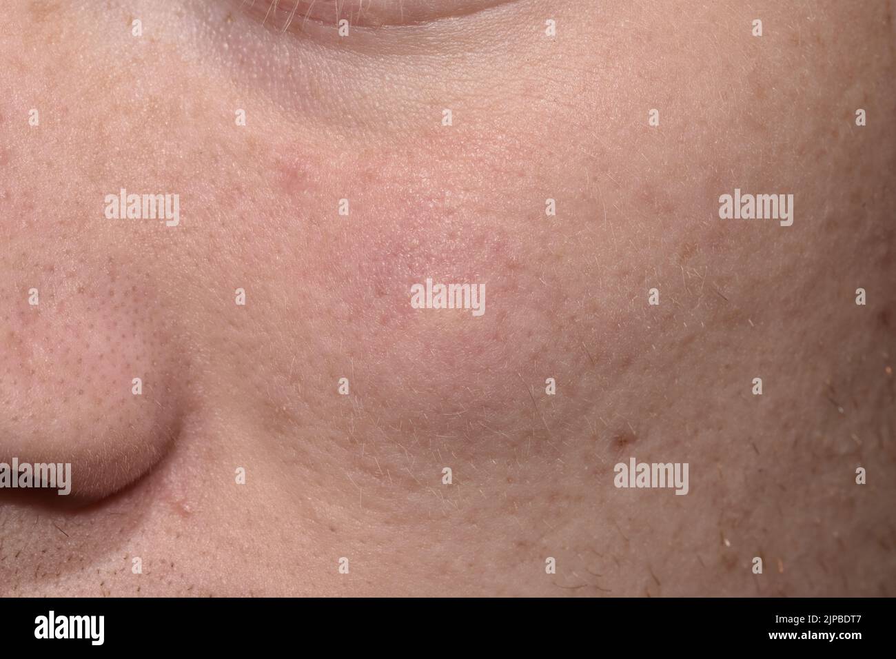 Epidermal Inclusion Cyst