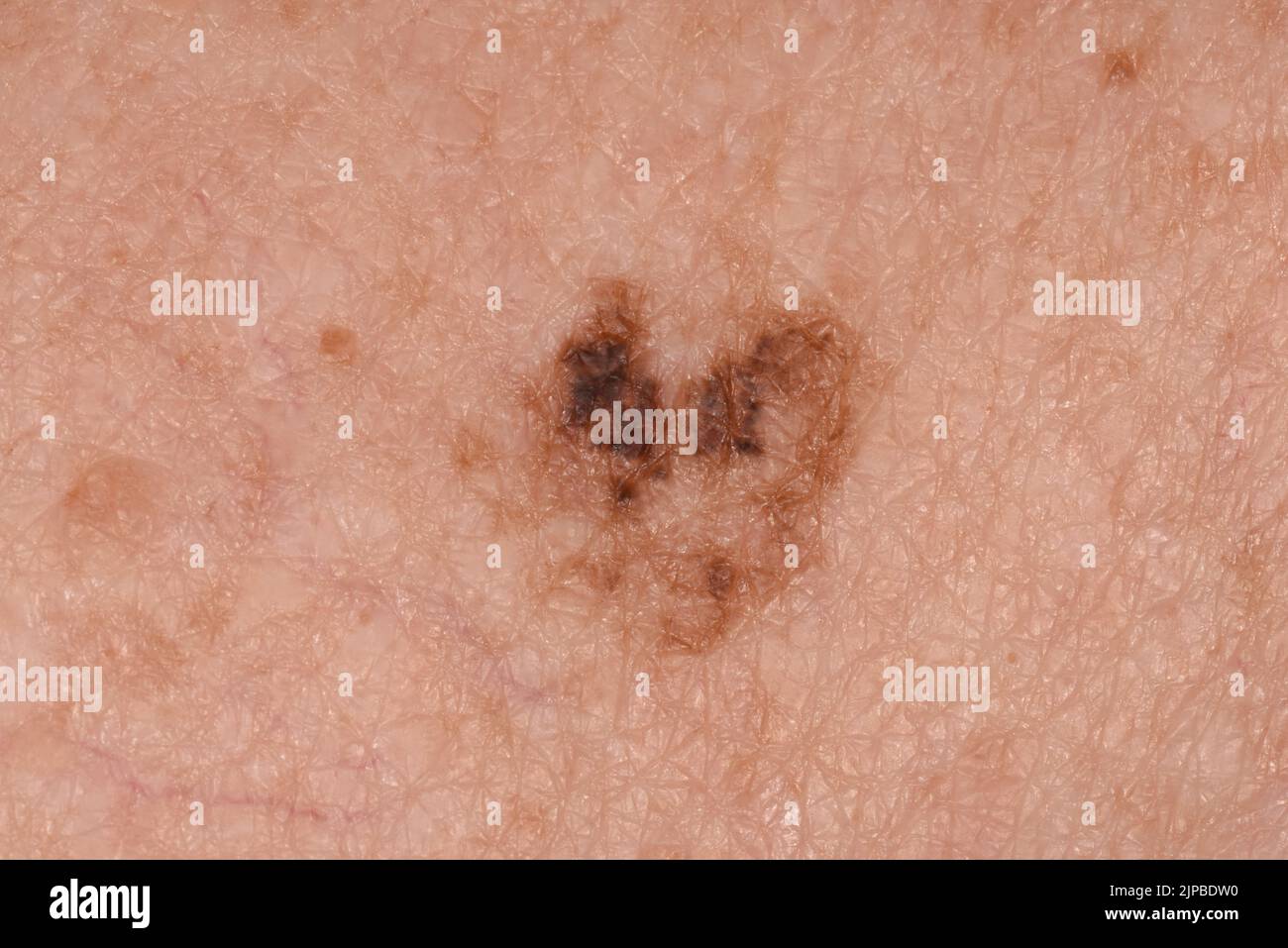 Mole on the skin Stock Photo - Alamy