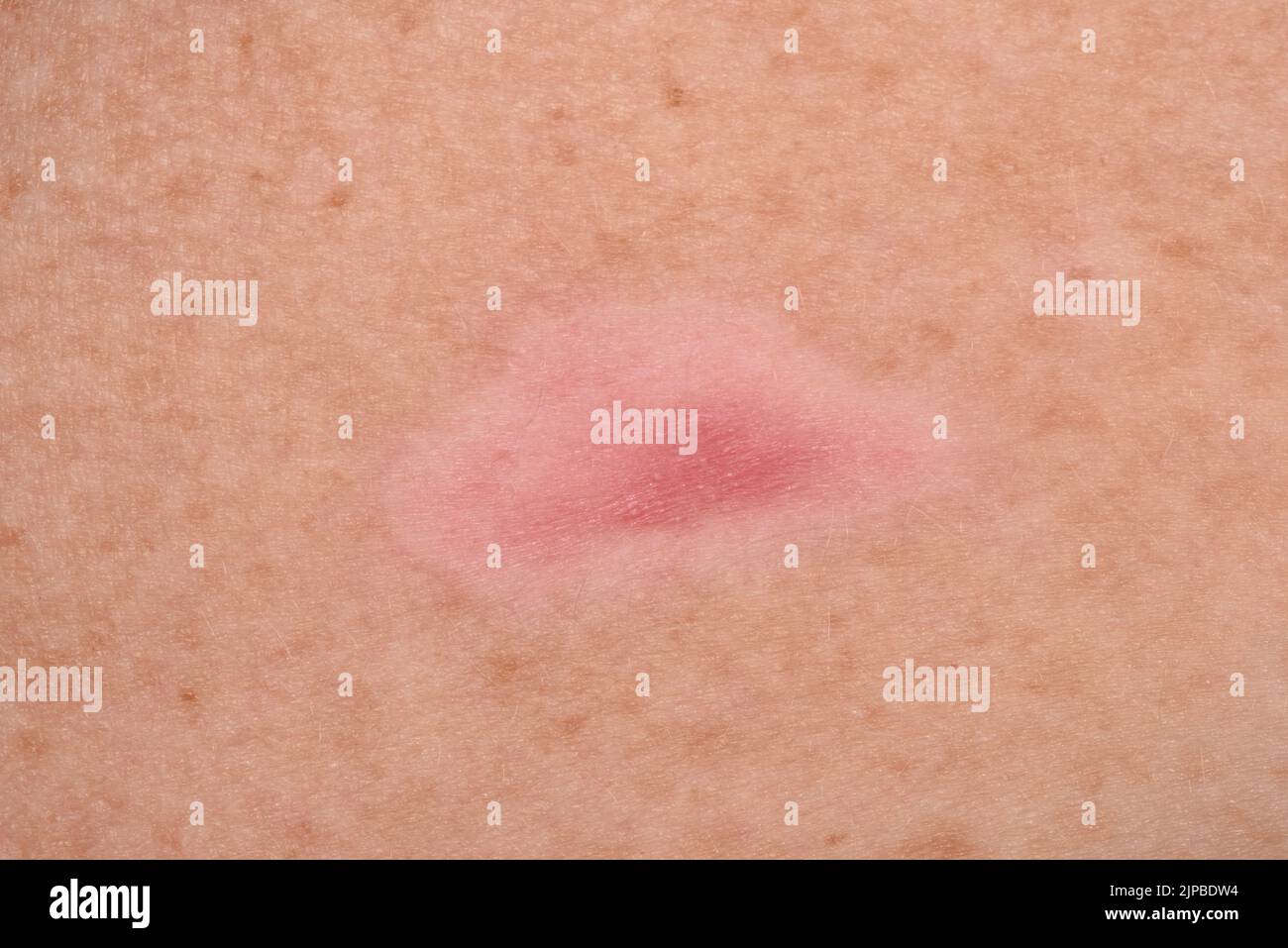 Bullous pemphigoid blister Stock Photo - Alamy