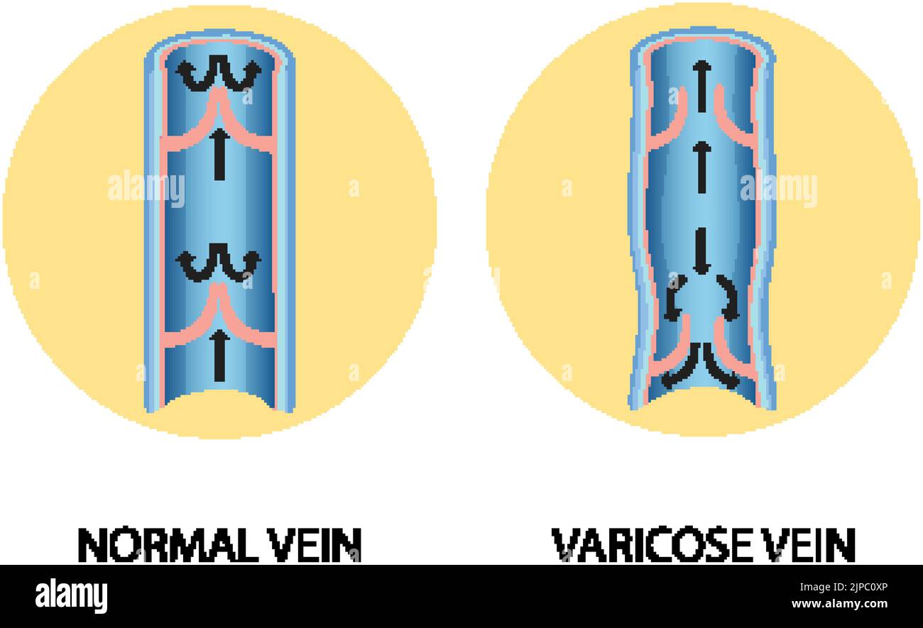 A comparison of normal vein with varicose vein illustration Stock ...