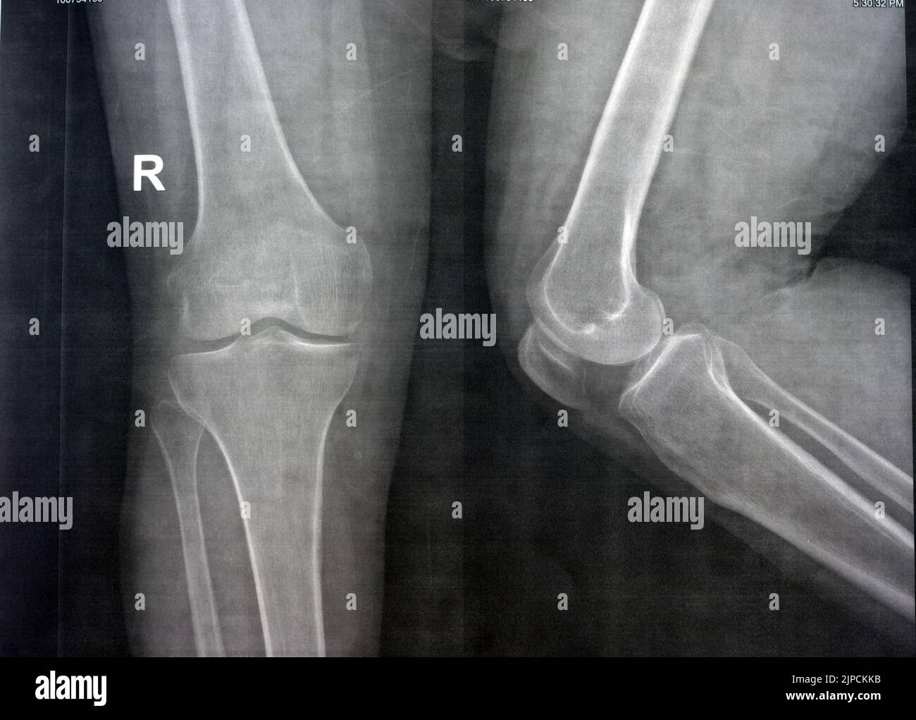 Plain X ray of the right knee shows apparent joint osteoarthritis ...