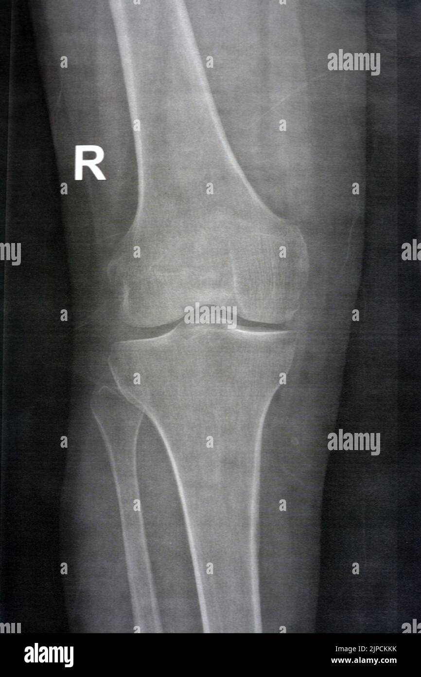 Plain X ray of the right knee shows apparent joint osteoarthritis ...