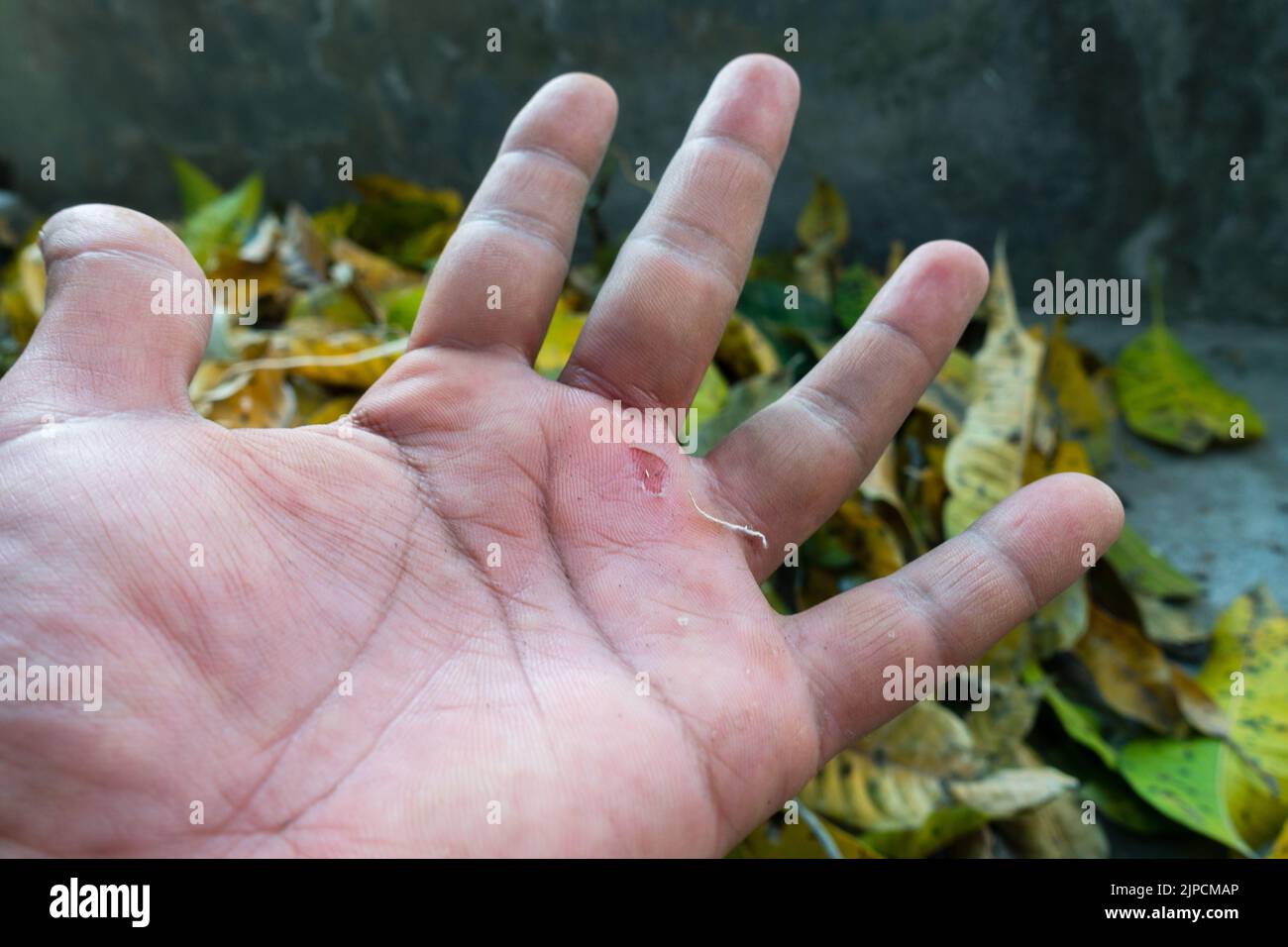 A close of a palm of an asian male adult with a blister after heavy ...