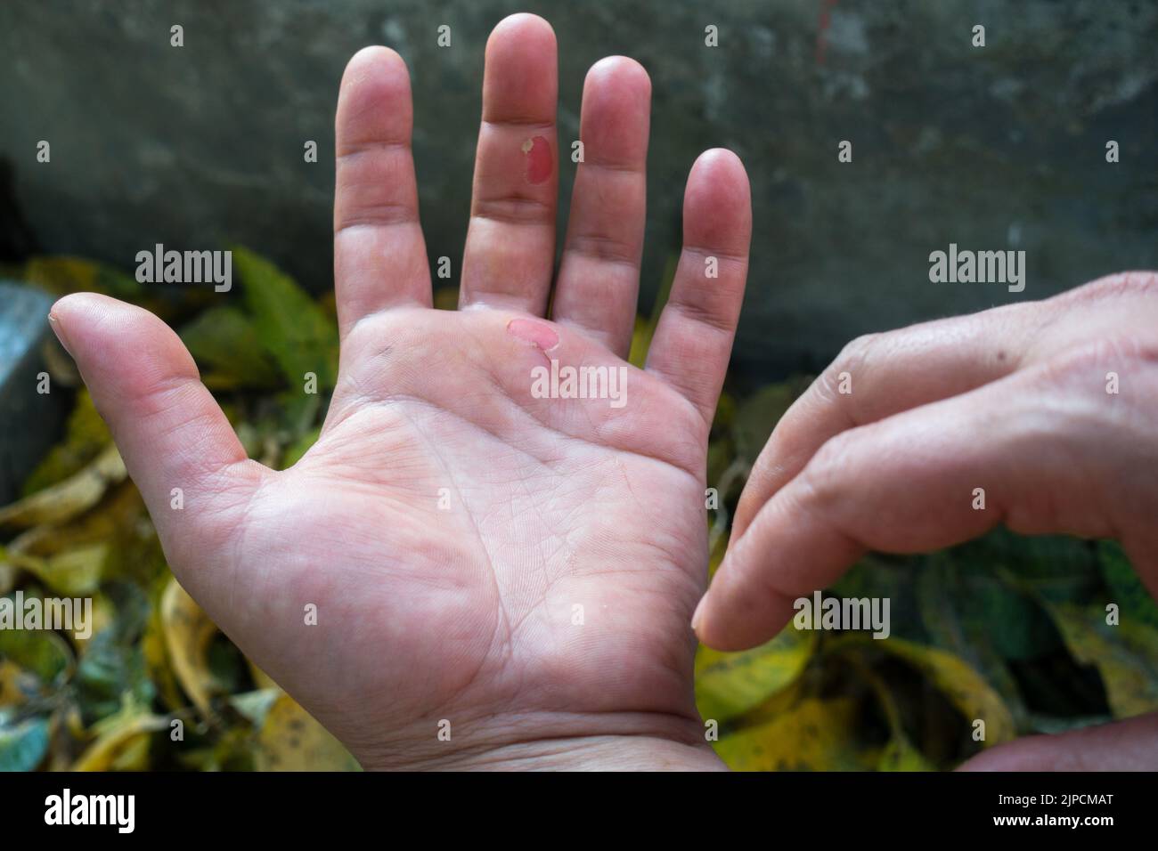A close of a palm of an asian male adult with a blister after heavy ...