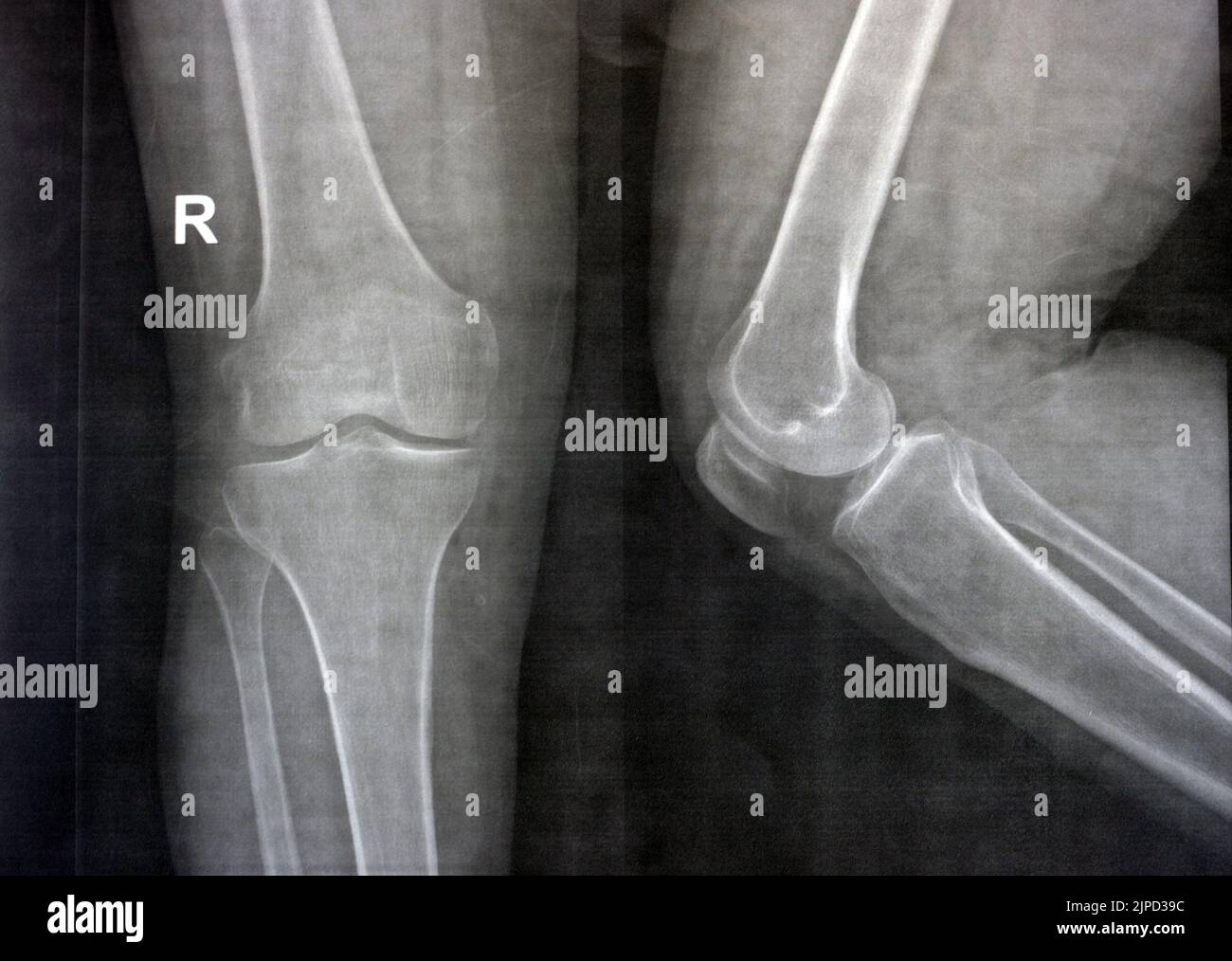 Plain X ray of the right knee shows apparent joint osteoarthritis ...