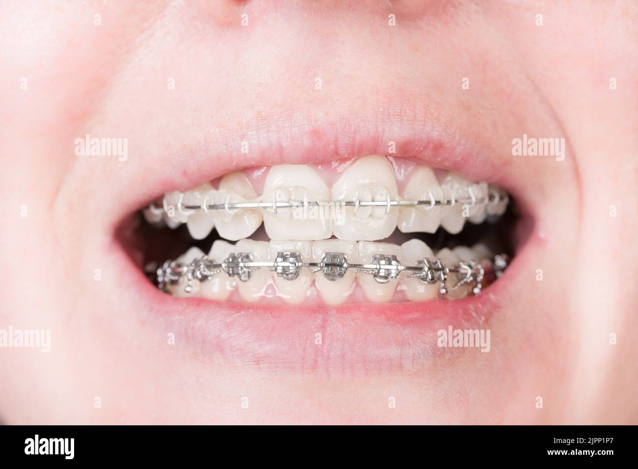 Womans smile tooth braces hi-res stock photography and images - Alamy