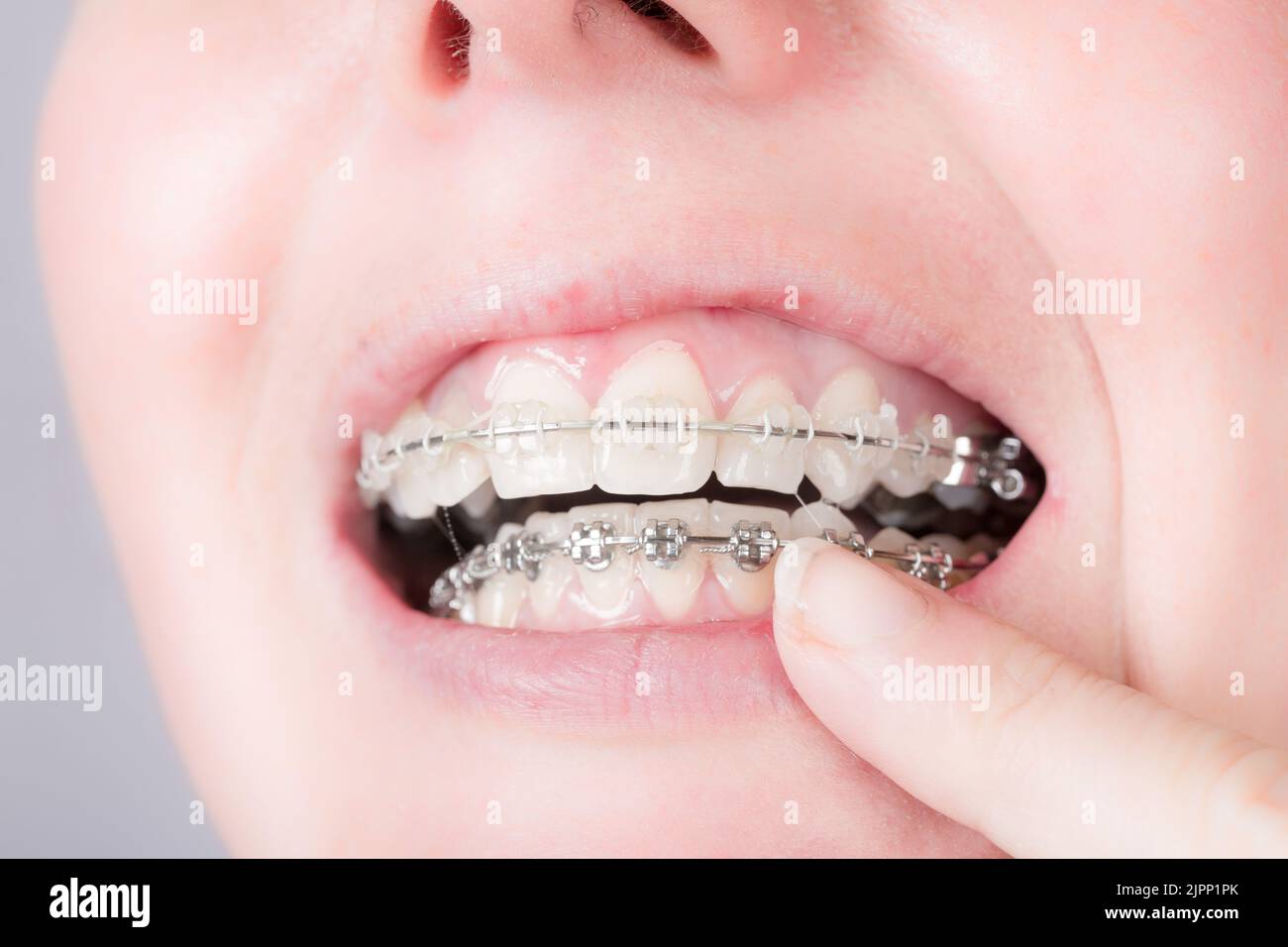 close-up of a woman's mouth pointing with her finger at dental brace ...