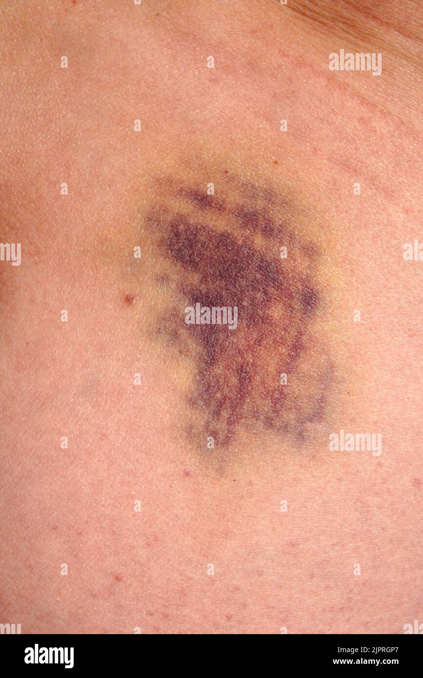 Draw blood hi-res stock photography and images - Alamy