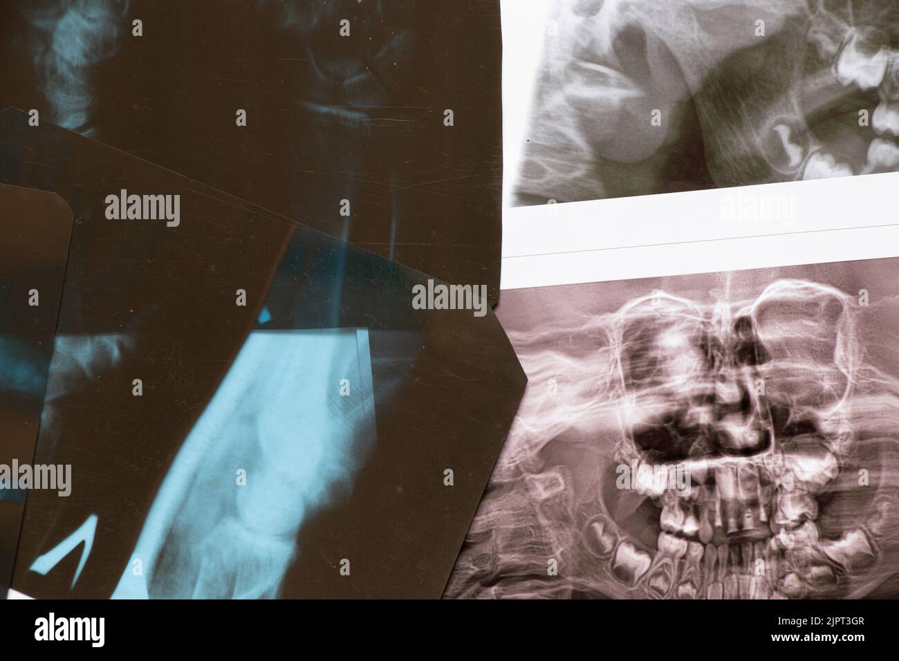 Skeleton pain x rays skull hi-res stock photography and images - Alamy