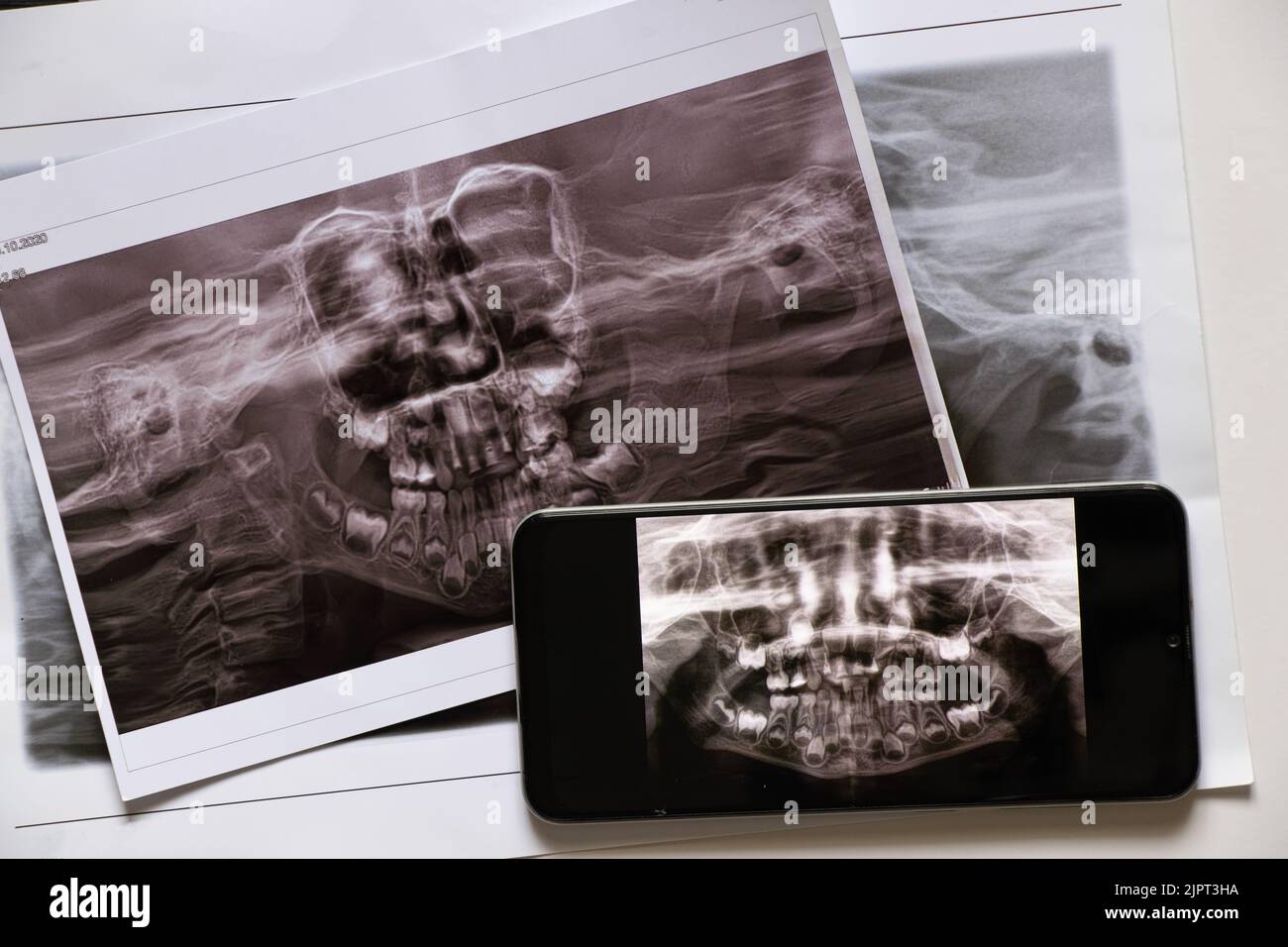Panoramic shot shows several embedded and impacted teeth on both the ...