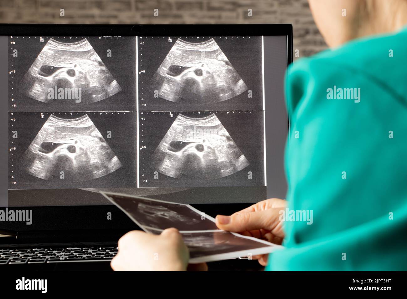 Ultrasound of a woman's abdomen on a laptop screen monitor in a doctor ...