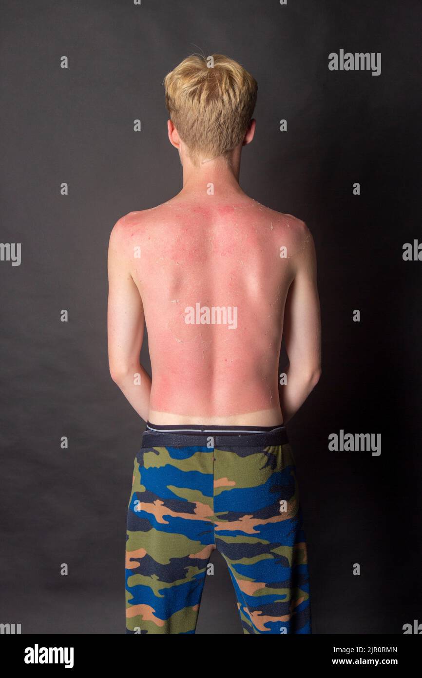 Sunburn vertical hi-res stock photography and images - Alamy